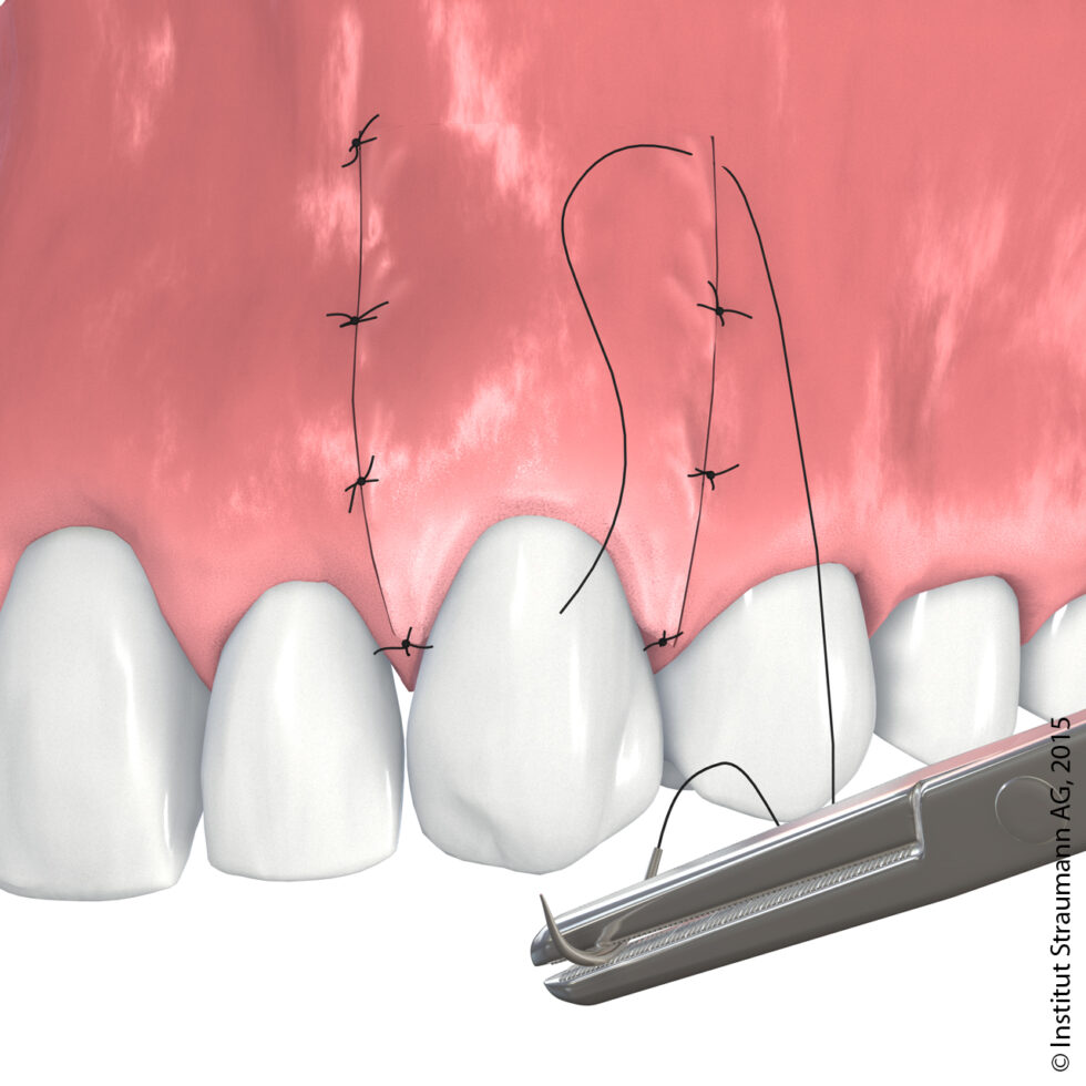 Weichgewebe - Dr. Philipp Rösch -Fachzahnarzt für Oralchirurgie
